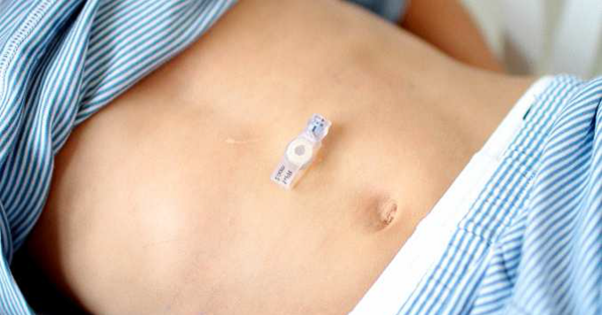 Hva er gastrostomi? - Oslo universitetssykehus HF